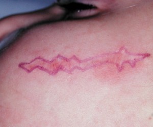 Geometric Facial Scar Revision Indianapolis Dr Barry Eppley - Explore ...