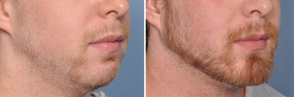 Chin and Jaw Angle Implants for Male Facial Enhancement - Explore ...