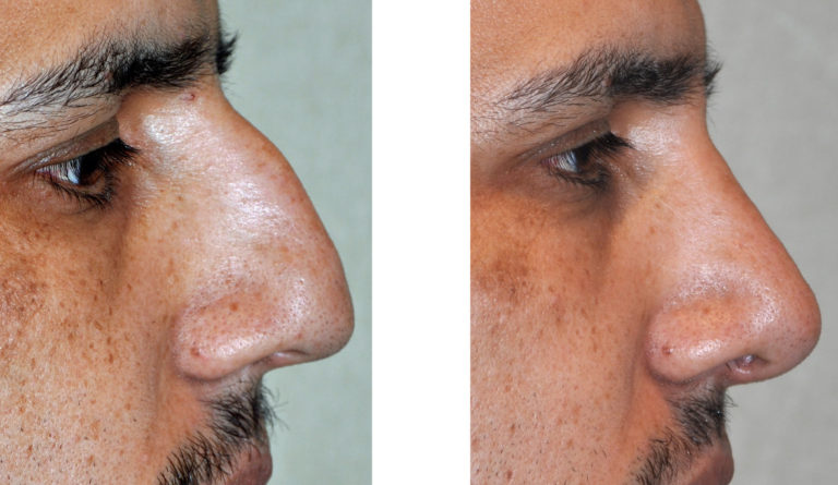 Plastic Surgery's Did You Know? The Roman Nose and Rhinoplasty ...