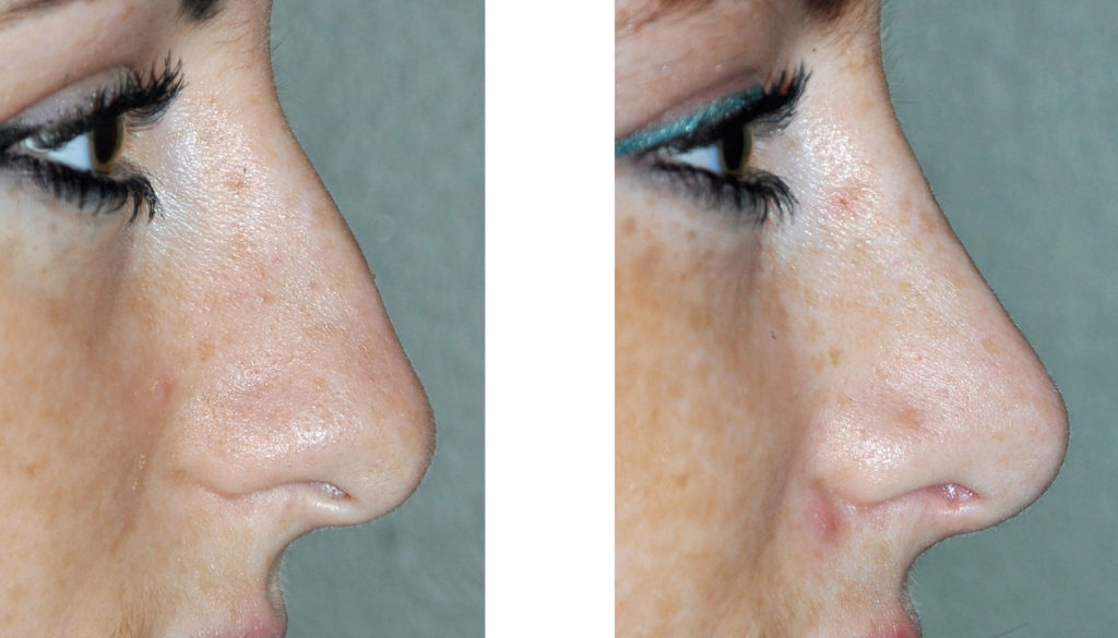 Principles of a Natural-Looking Rhinoplasty - Explore Plastic Surgery