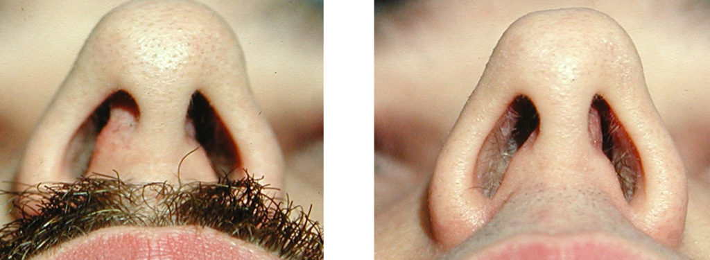 Septoplasty (Deviated Septum) in Rhinoplasty Dr Barry Eppley ...