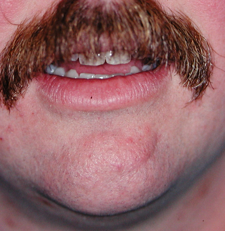 chin scar revision after - Explore Plastic Surgery