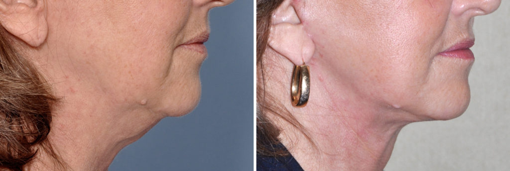 Different Types of Facelifts - Explore Plastic Surgery Different Types of Facelifts - Explore Plastic Surgery