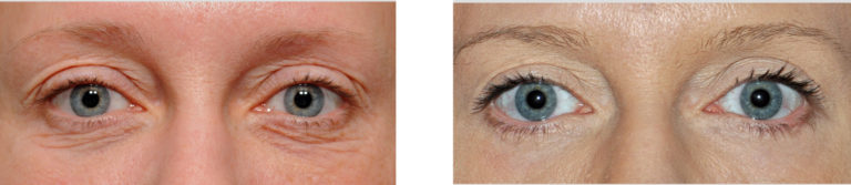 The Pinch and Peel Lower Blepharoplasty - Explore Plastic Surgery