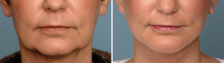 Reshaping the Aging Lower Face - Explore Plastic Surgery