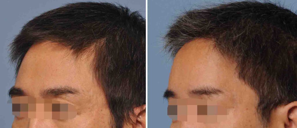 Forehead and Brow Bone Augmentation using PMMA Bone Cement - Explore ...