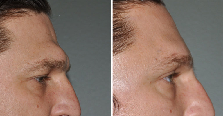 Options for Brow Bone Reduction in Men and Women - Explore Plastic Surgery