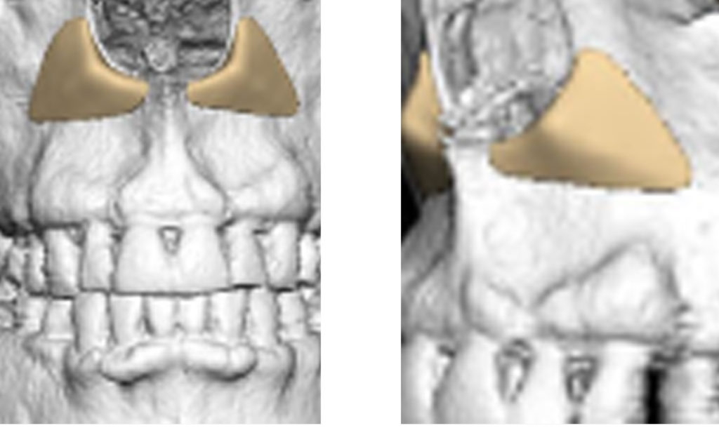 Paranasal Implants - The Facial Implant You Never Heard Of - Explore ...