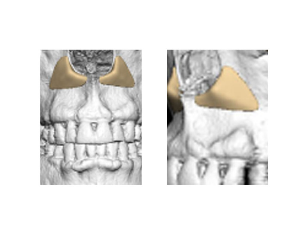 Paranasal Implant Designs Dr Barry Eppley Indianapolis - Explore ...