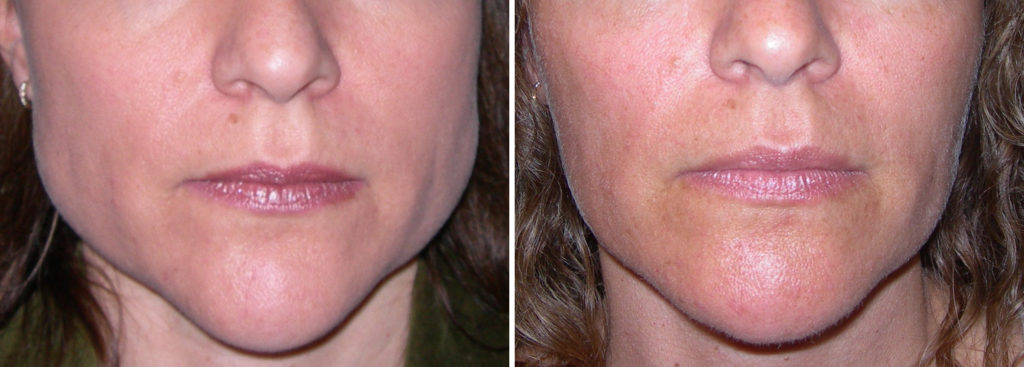 Surgical vs. Non-Surgical Jaw Angle Reduction - Explore Plastic Surgery Surgical vs. Non-Surgical Jaw Angle Reduction - Explore Plastic Surgery