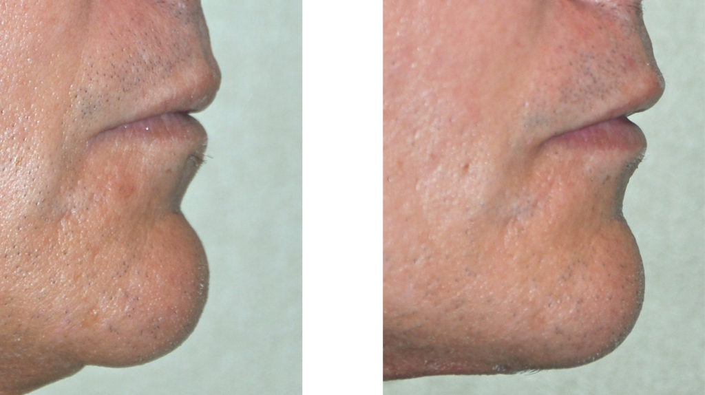 The Use Of Injectable Fillers For The Deep Labiomental Fold - Explore ...