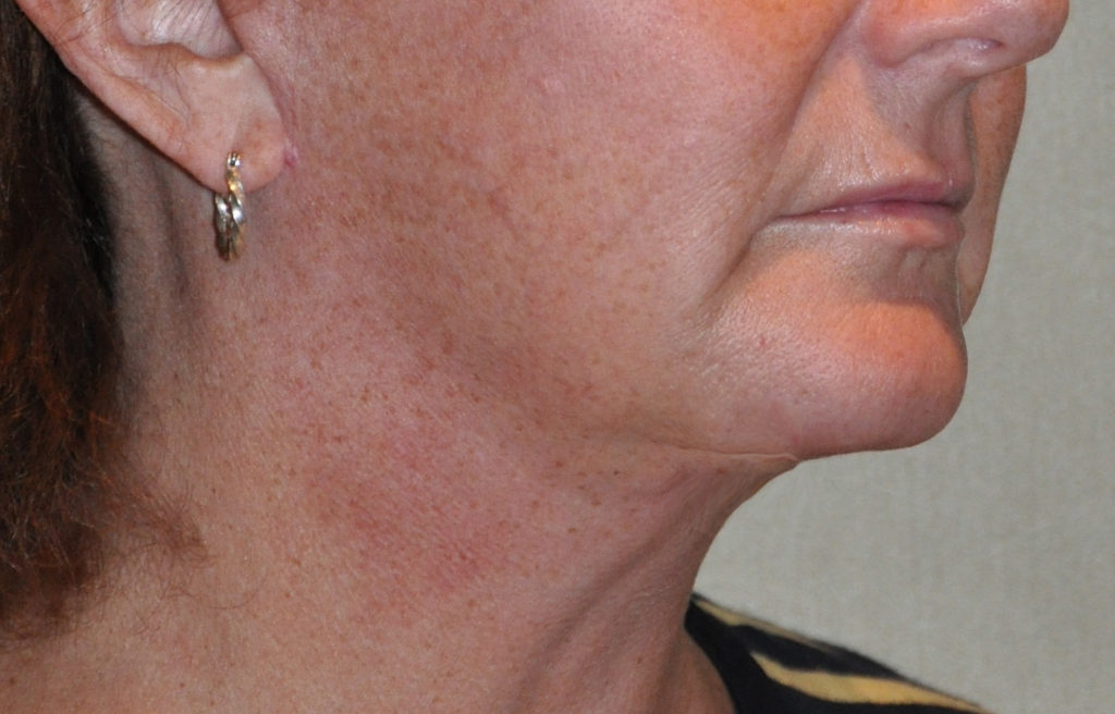 Rebound Relaxation After Facelift Surgery - Explore Plastic Surgery