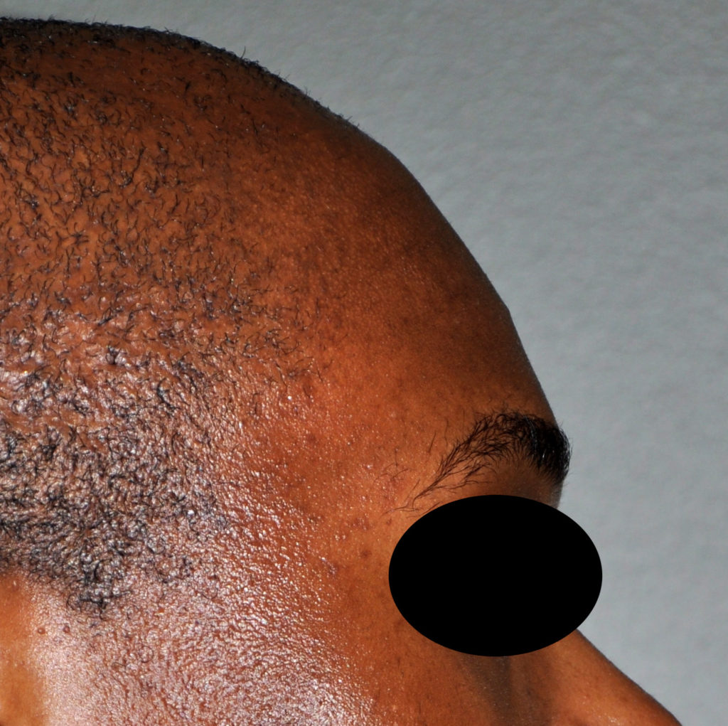 Forehead Augmentation With Bone Cements - Explore Plastic Surgery