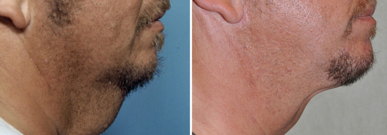 Getting Rid of the Turkey Neck in Massive Weight Loss Patients ...