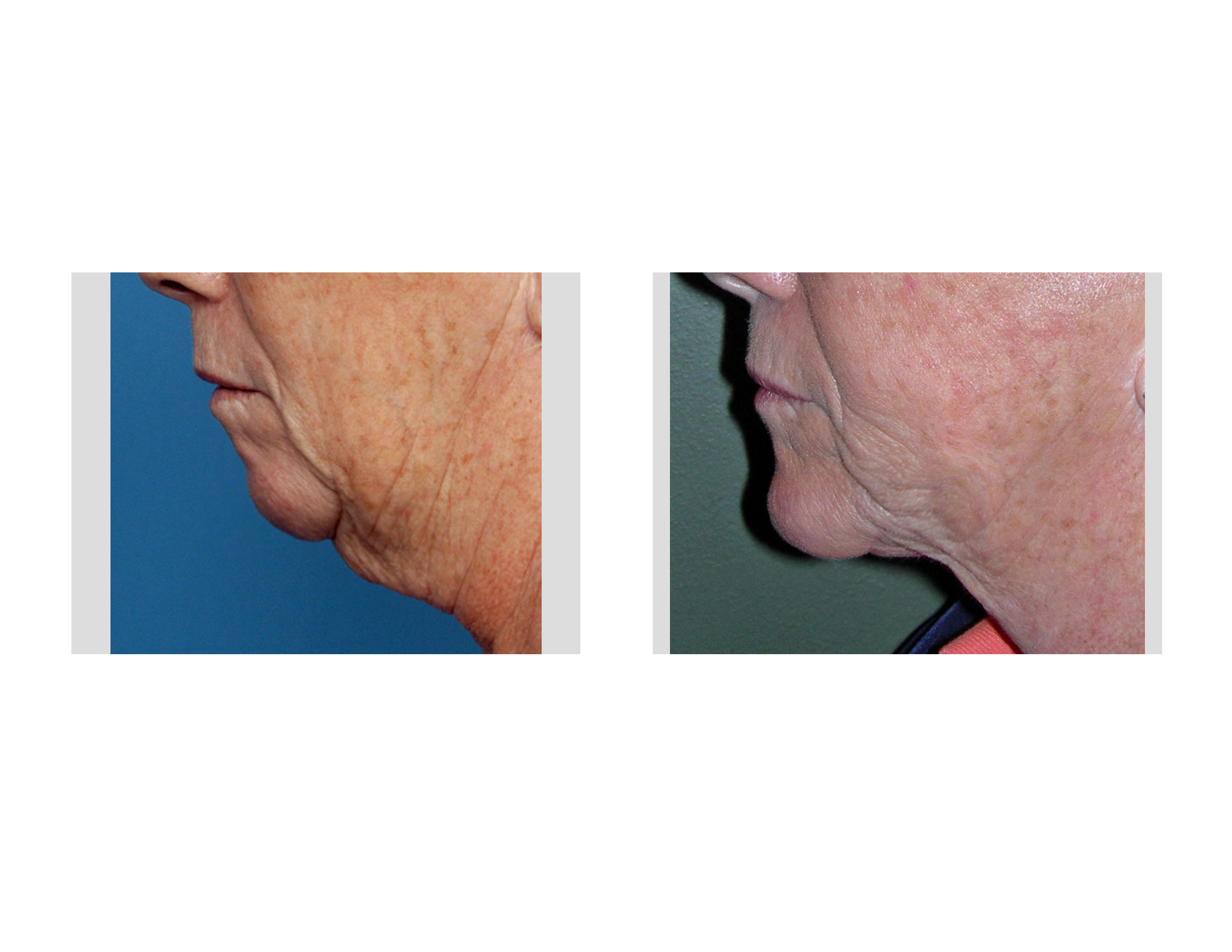 facelift-with-chin-implant-indianapolis-dr-barry-eppley - Explore ...