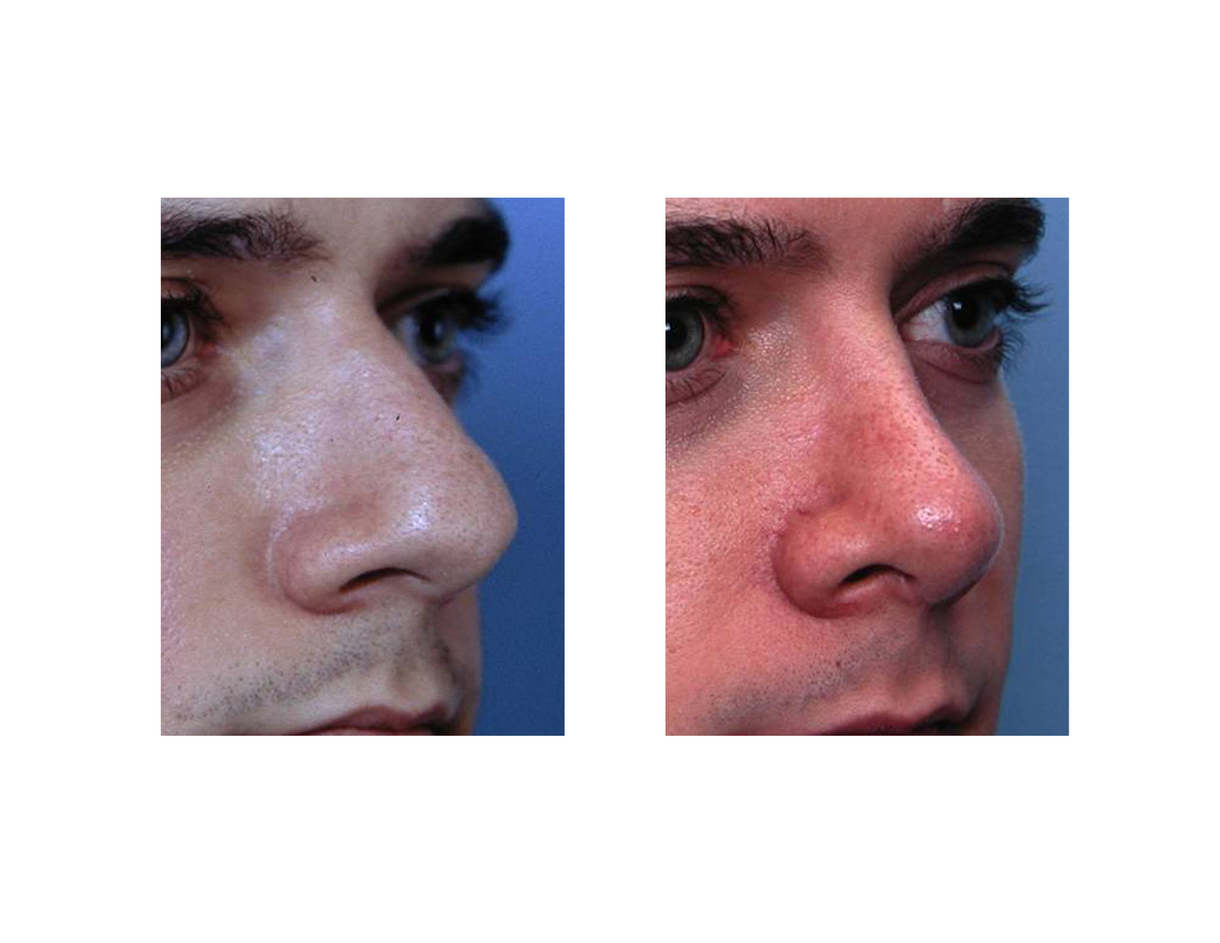 rhinoplasty-nosejob-dr-barry-eppley-indianapolis - Explore Plastic Surgery