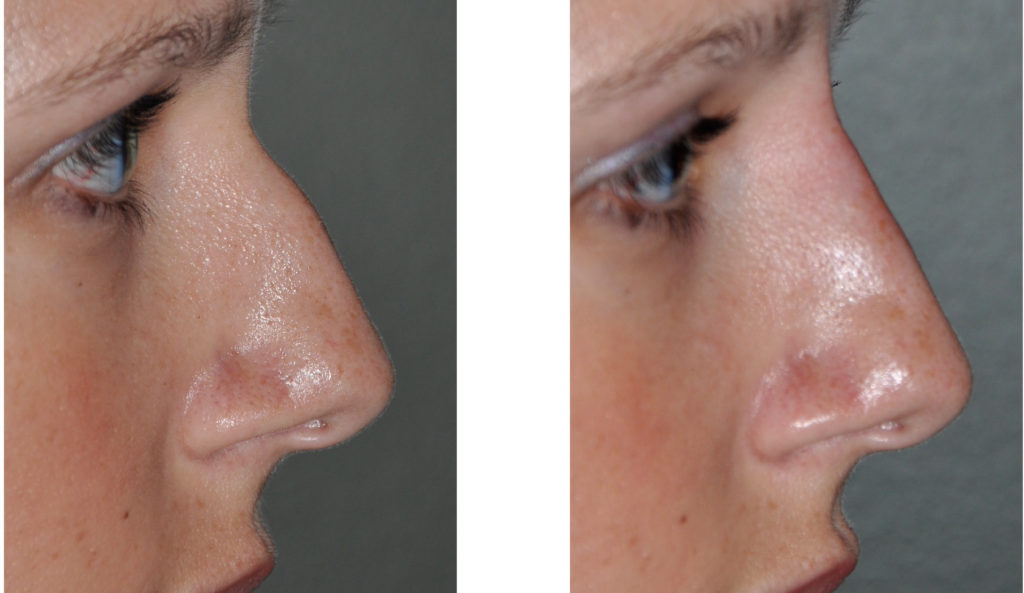 Injectable Rhinoplasty - A Quick and Temporary Fix - Explore Plastic ...