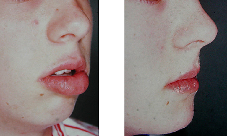 Reducing the Size of the Lips - Explore Plastic Surgery