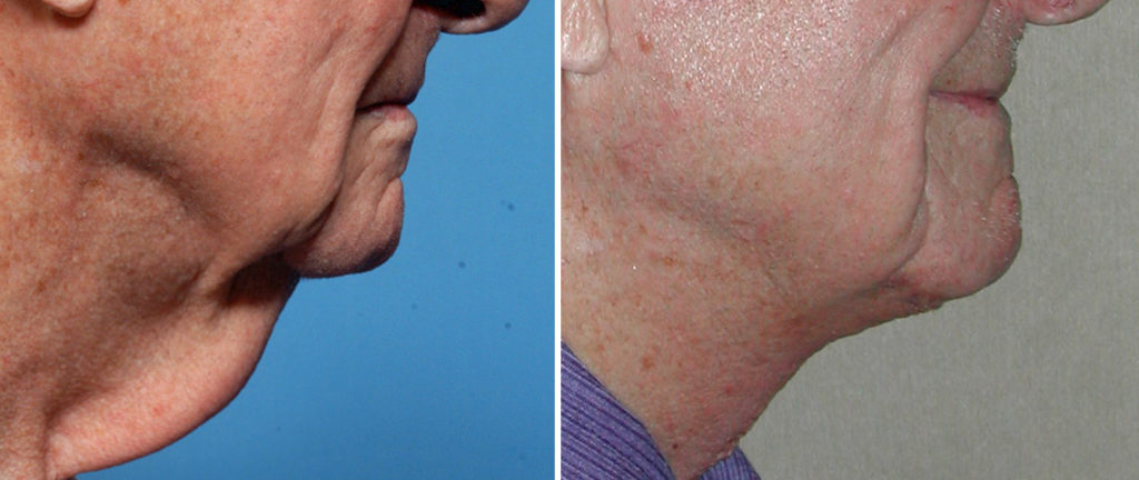 Necklifting in the Older Patient - Explore Plastic Surgery