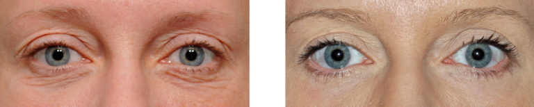 A Lower Blepharoplasty for Younger Patients - The Pinch and Peel ...