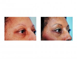 blepharoplasty-upper-eyelid-tuck-dr-barry-eppley-indianapolis - Explore ...