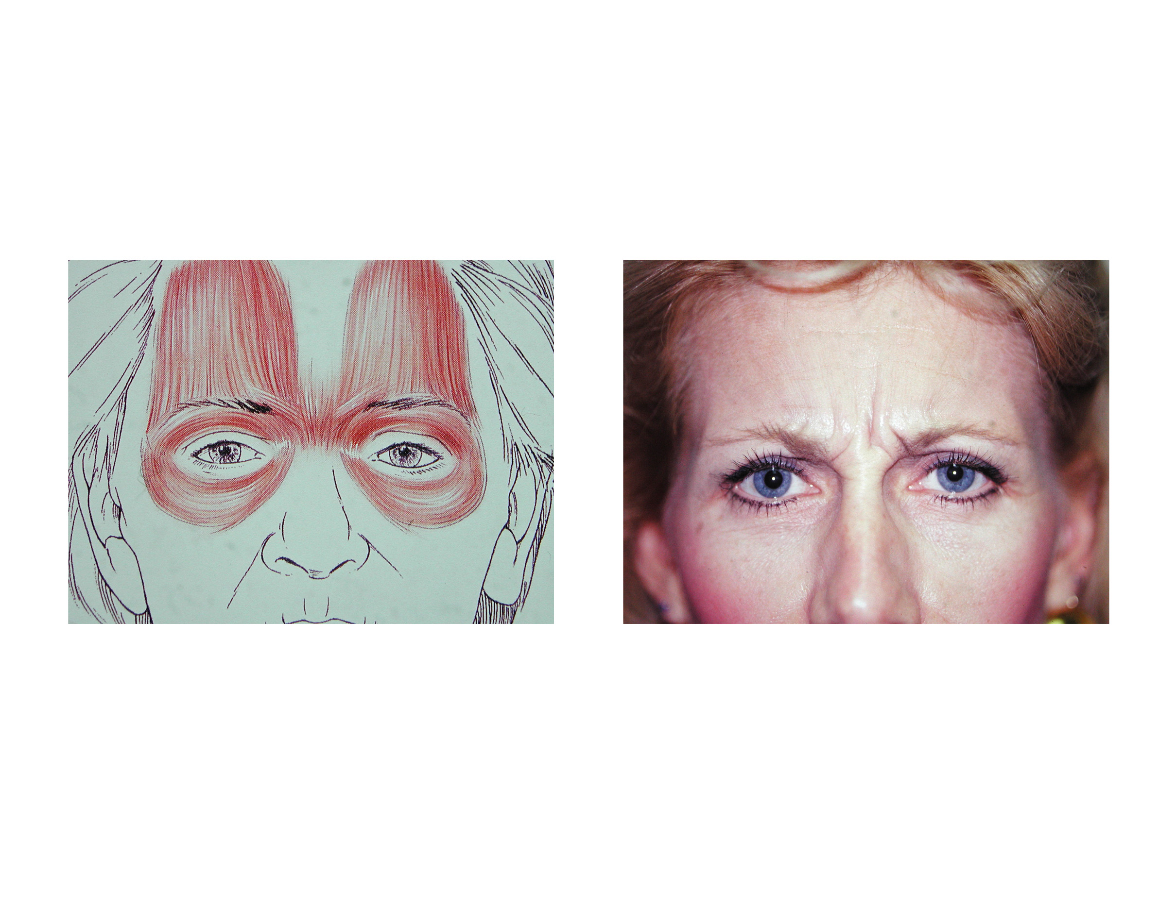 botox-injections-dr-barry-eppley-indianapolis - Explore Plastic Surgery