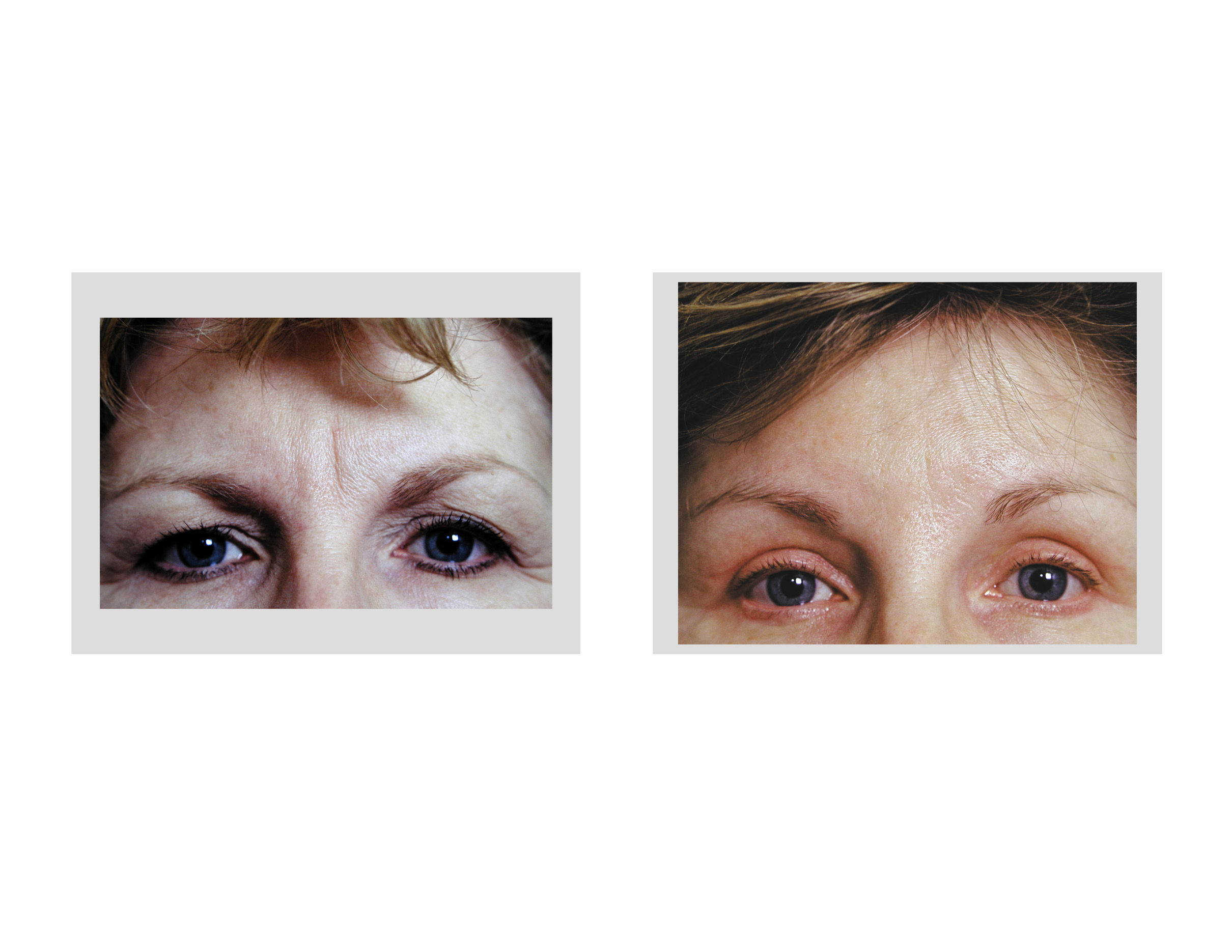 browlift-and-blepharoplasty-indianapolis-dr-barry-eppley - Explore ...