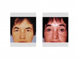 browlift-endoscopic-indianapolis-dr-barry-eppley - Explore Plastic Surgery