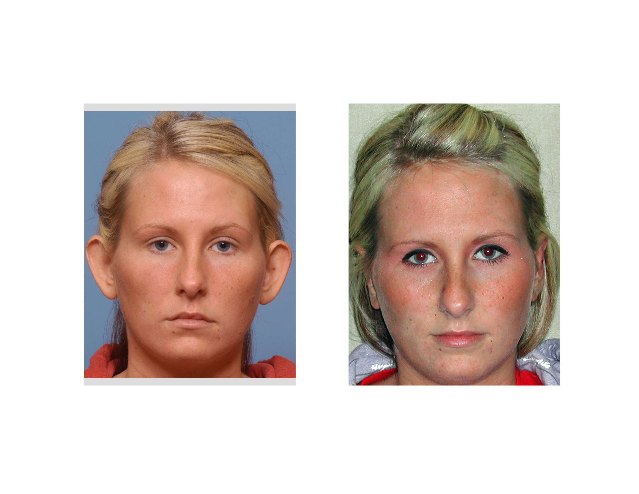 ear-setback-otoplasty-indianapolis-dr-barry-eppley1 - Explore Plastic ...