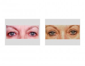 eyelid-tucks-blepharoplasty-dr-barry-eppley-indianapolis - Explore ...