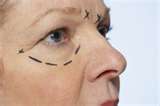 lower-blepharoplasty-pinch-and-peel-dr-barry-eppley-indianapolis ...
