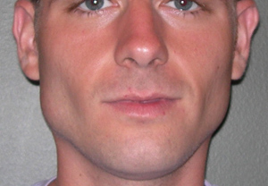 masseter-muscle-reduction-with-botox-injections-dr-barry-eppley ...