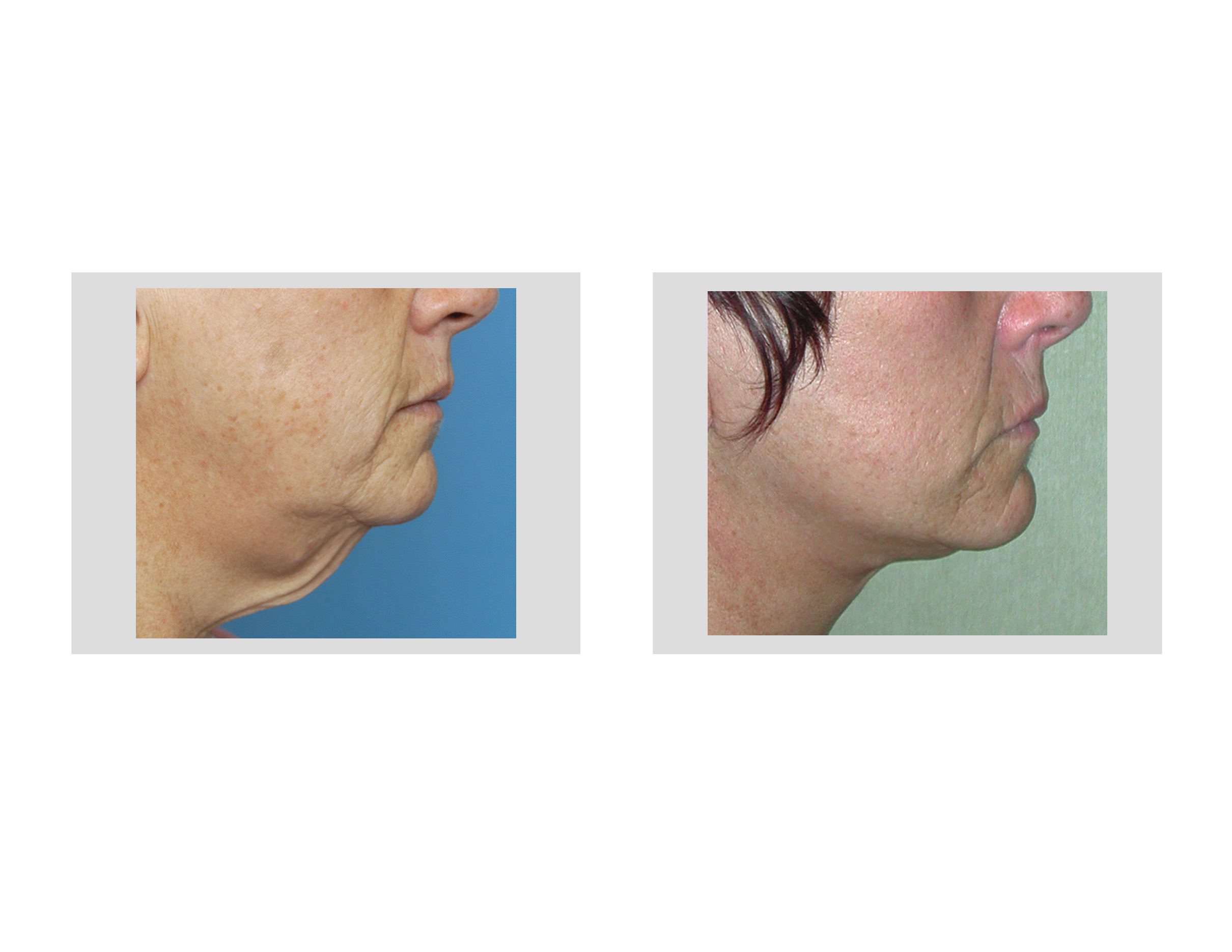 necklift-indianapolis-dr-barry-eppley - Explore Plastic Surgery