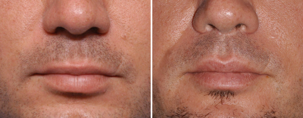 Lip Advancements and Lip Lifts for Lip Enhancement - Explore Plastic ...