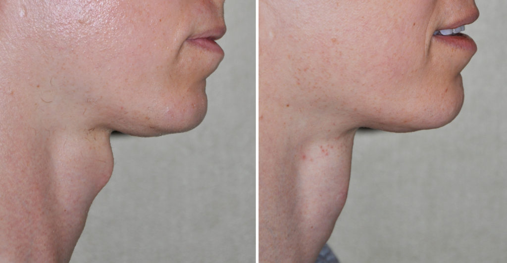 Tracheal Shave (Adam's Apple Reduction) for Neck Contouring - Explore ...