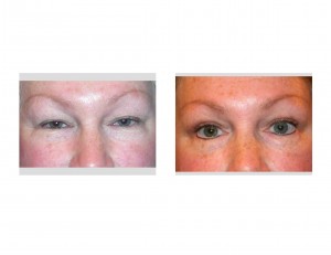 indianapolis-blepharoplasty-dr-barry-eppley-indianapolis - Explore ...