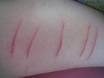 self-mutilation-scar-revision-dr-barry-eppley-indianapolis - Explore ...
