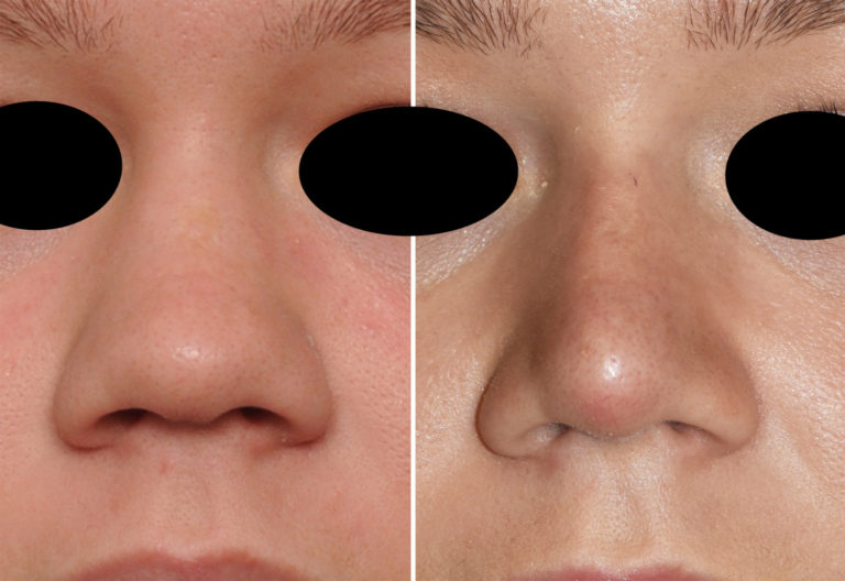 Rhinoplasty for Wide Noses - Explore Plastic Surgery