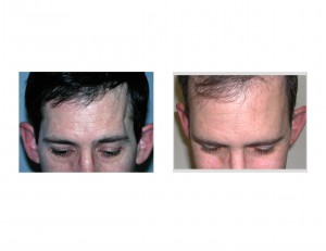 temporal-augmentation-dr-barry-eppley-indianapolis - Explore Plastic ...