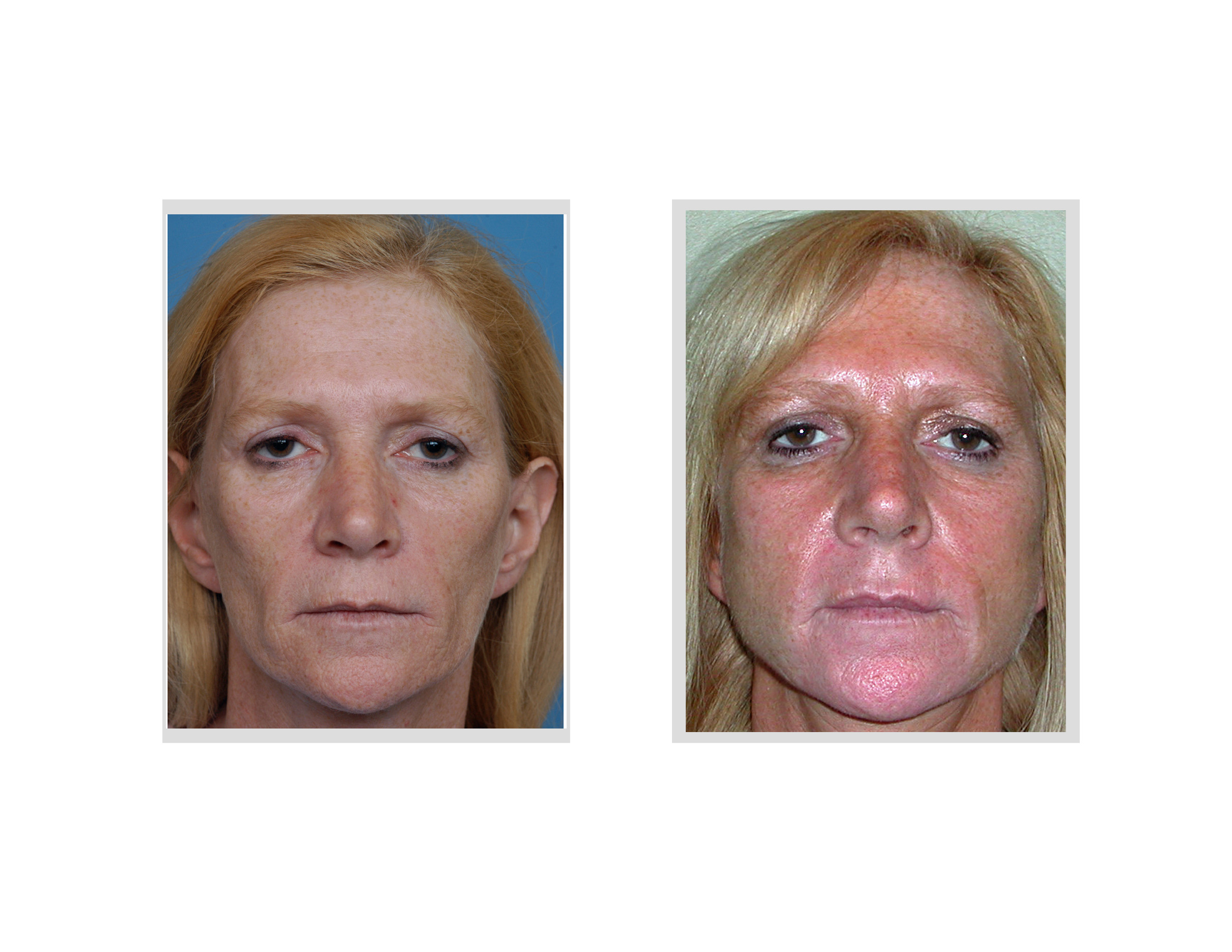 volumetric-facial-sculpting-with-fat-injections-dr-barry-eppley ...