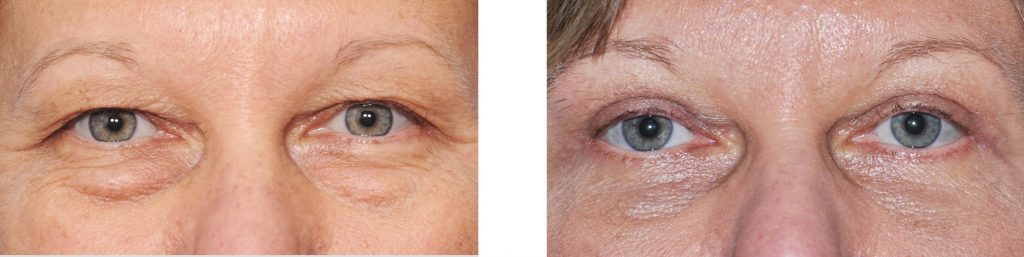 The Anatomy of Periorbital Aging and Rejuvenation - Explore Plastic Surgery