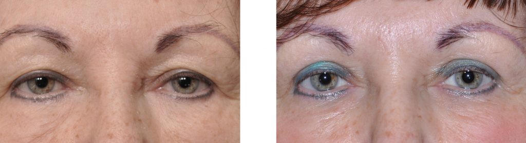 The Anatomy of Periorbital Aging and Rejuvenation - Explore Plastic Surgery