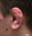 cauliflower-ear-correction-dr-barry-eppley-indianapolis2 - Explore ...