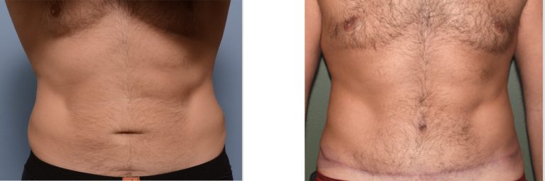 The Male Tummy Tuck (Lipoabdominoplasty) - Explore Plastic Surgery