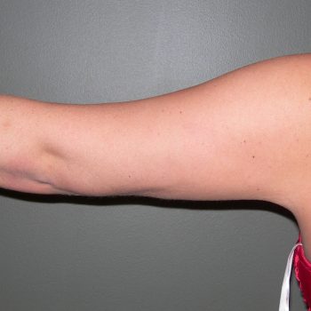 Smartlipo Arm Contouring - Explore Plastic Surgery