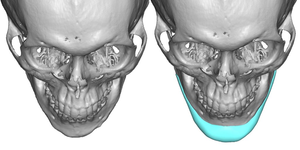 Corrective Surgery for Lower Facial (Jaw) Asymmetry - Explore Plastic ... Corrective Surgery for Lower Facial (Jaw) Asymmetry - Explore Plastic ...