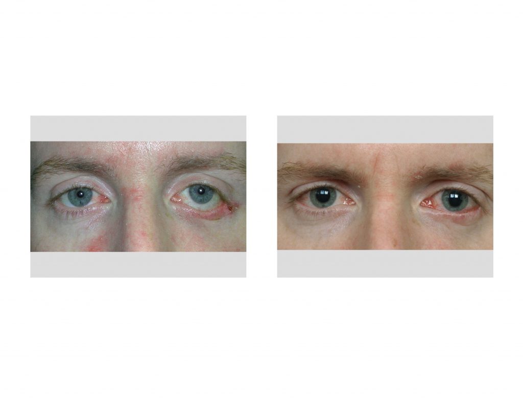 Secondary Revisions of Soft Tissue Problems of Cheekbone (Zygomatic ...