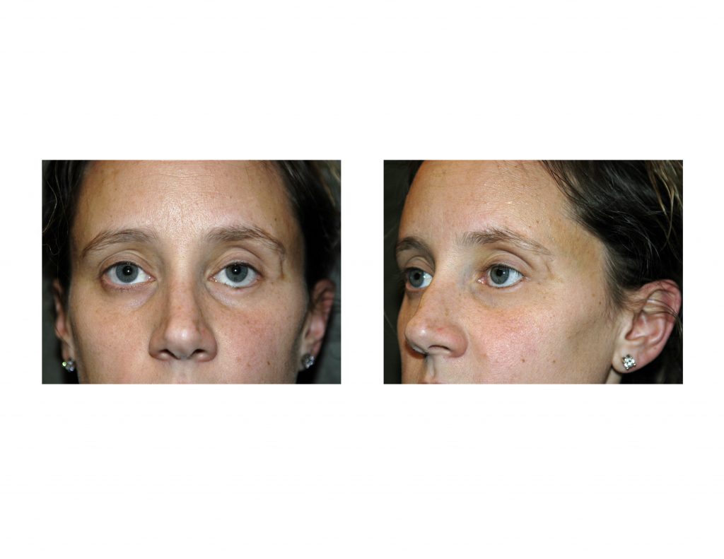 Secondary Revisions of Soft Tissue Problems of Cheekbone (Zygomatic ...