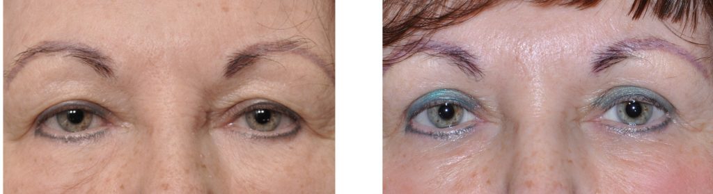 Contemporary Upper Blepharoplasty (Eyelid Tuck) - Less is More ...
