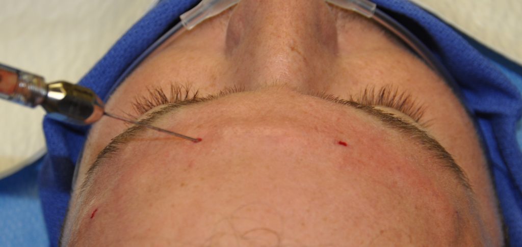 Injectable Eyebrow/Brow Bone Augmentation - Explore Plastic Surgery